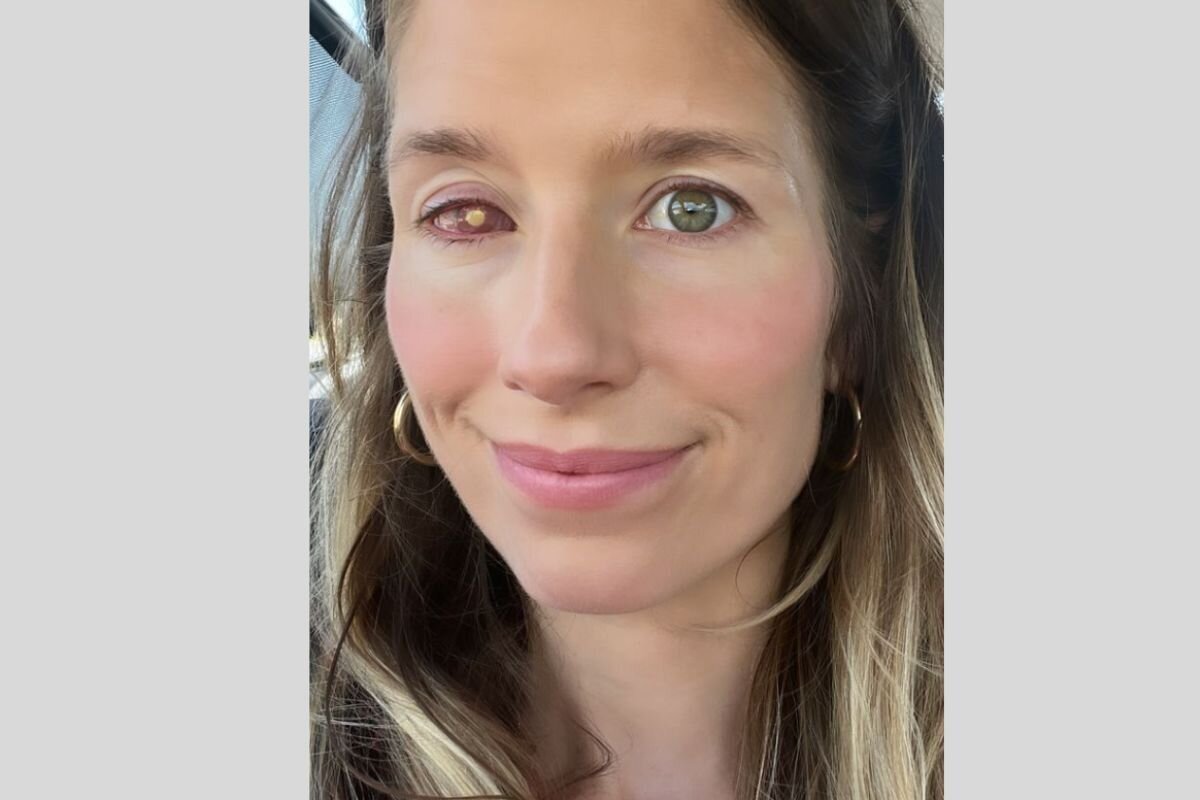 L'histoire de Rachel Prochnow face à la kératite amibienne et la cécité ...